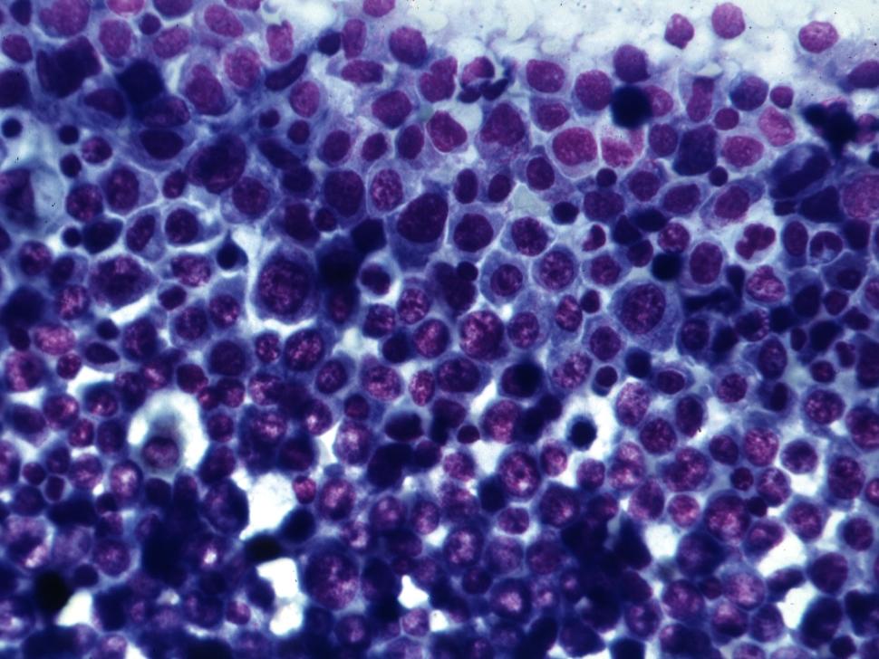 MyeloMATCH Presentations at ASH 2025 - NCI